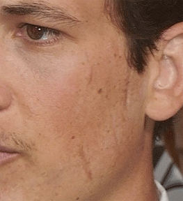 2015 Skinnies Awards: Miles Teller, Facial Scars